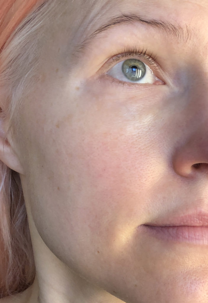 Punoittavan ihon hoito: couperosa, rosacea, akne, ärtynyt iho - Karkkipäivä